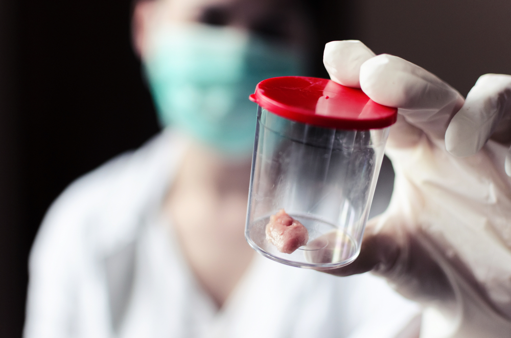 Biópsia pulmonar: para que serve e como funciona? - Clínica TxTórax